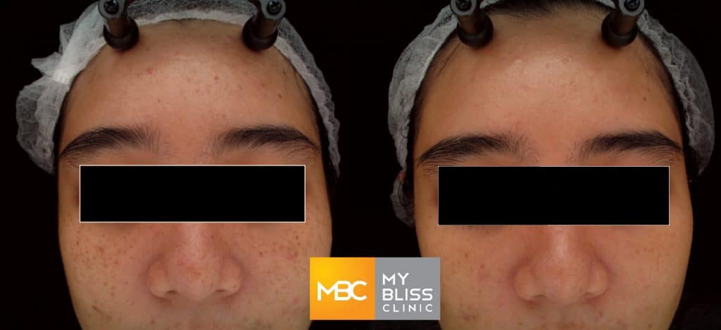 Skin Pigmentation Treatment in Kuala Lumpur | My Bliss Clinic