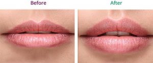 Laser Lip Remodeling | My Bliss Clinic
