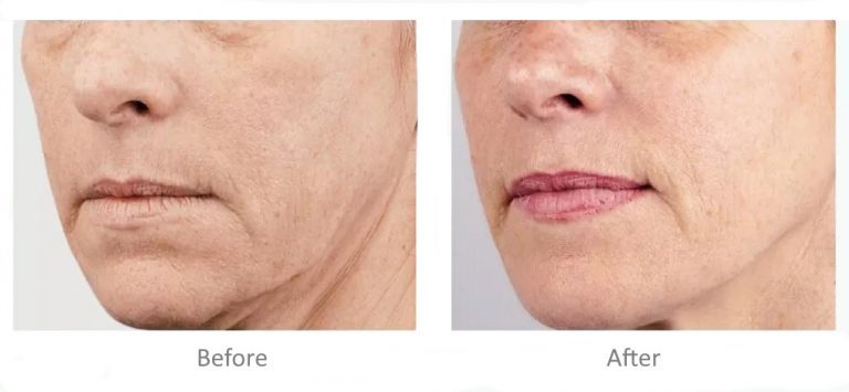 before after redensity 1-2 | My Bliss Clinic